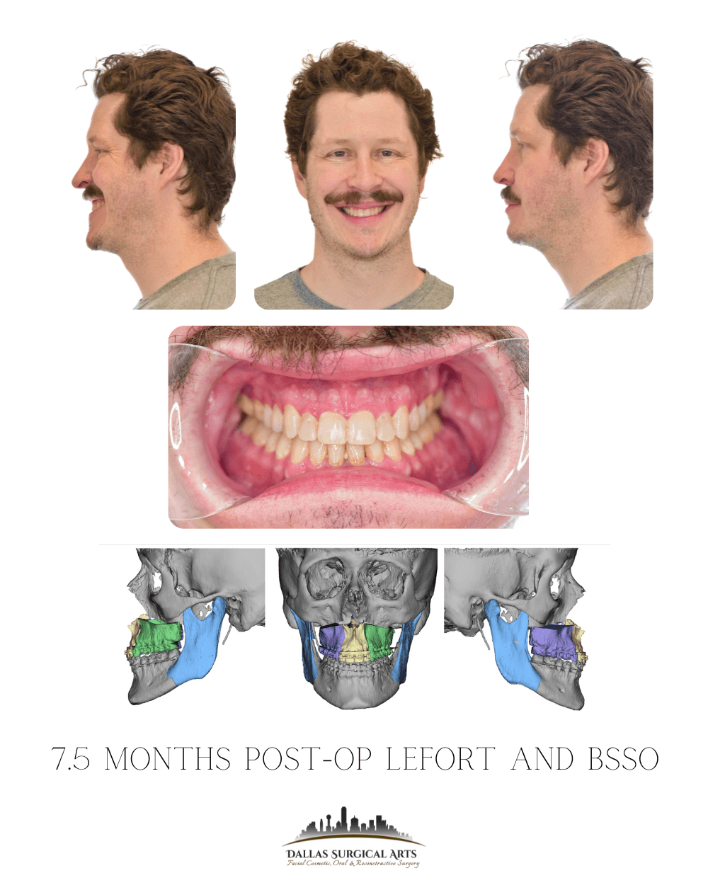 Jaw Repositioning (Orthognathic Surgery) | Dallas Surgical Arts
